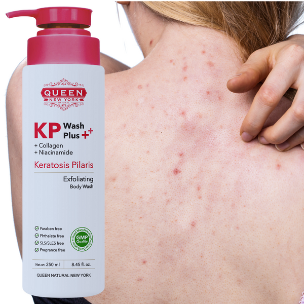 QUEEN KP Body Acne Keratosis Pilaris Exfoliating Body Wash Plus Collag ...